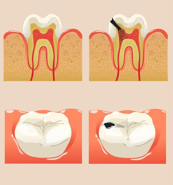 Detailed Illustration of Healthy and Unhealthy Teeth Anatomy | Jiffy ...