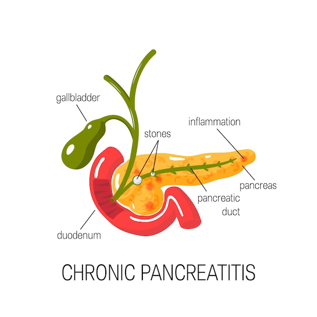 Detailed Anatomical Illustration of Chronic Pancreatitis | Jiffy Designs