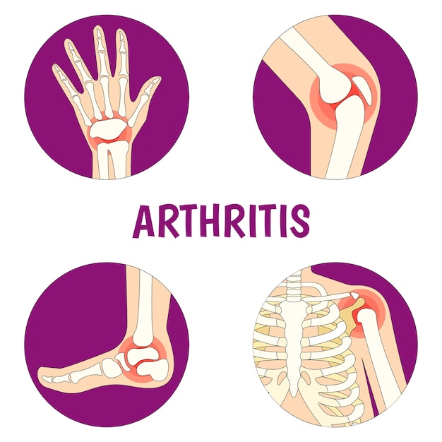 Comprehensive Arthritis Anatomy Illustration Collection | Jiffy Designs