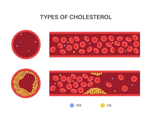 Detailed Illustration of Different Cholesterol Types | Jiffy Designs