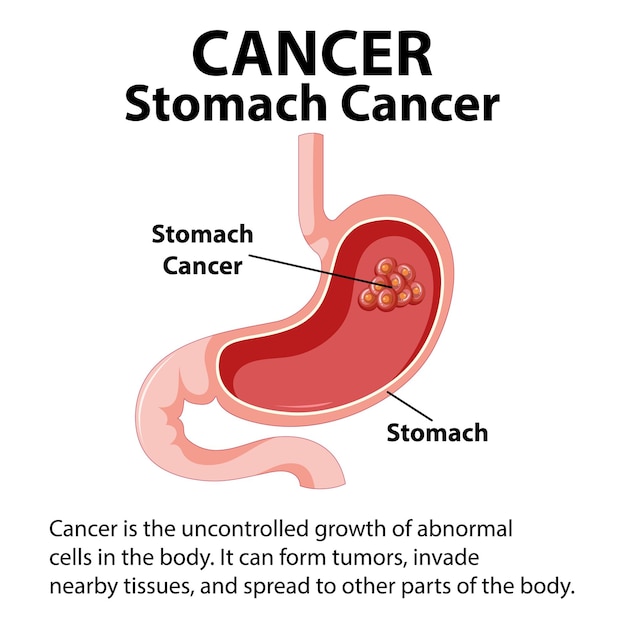 Detailed Illustration of Stomach Cancer and Its Effects | Jiffy Designs