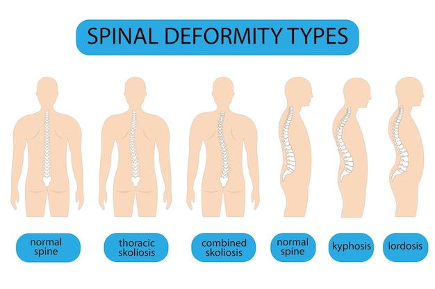 Detailed Illustrations of Spinal Deformity Types in Human Figures ...