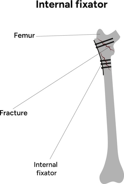 Detailed Illustration of an Internal Femur Fixator Device | Jiffy Designs