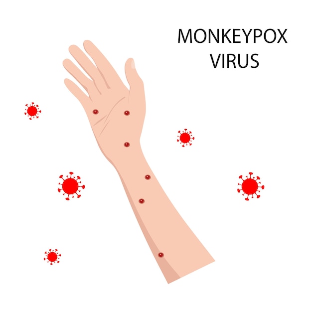 Monkeypox Outbreak: Arm Afflicted with Viral Lesions | Jiffy Designs