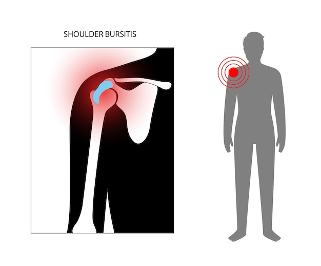 Detailed Anatomy of Shoulder Bursitis Condition | Jiffy Designs