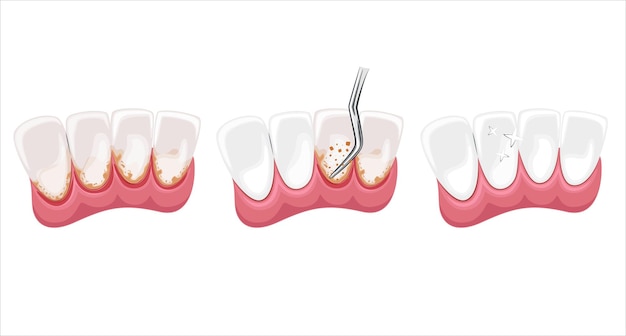 Dental Procedure Sequence Illustrating Tooth Cleaning and Restoration ...