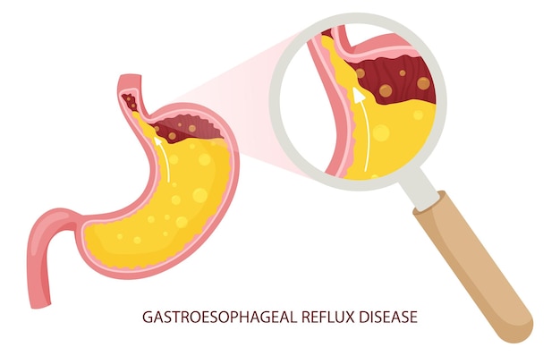 Detailed Illustration of Gastroesophageal Reflux Disease | Jiffy Designs