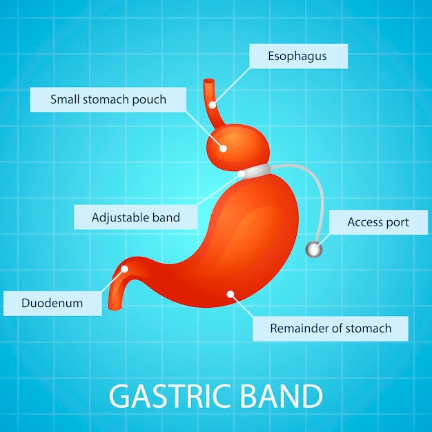 Detailed Diagram of a Gastric Band Surgical Implant | Jiffy Designs