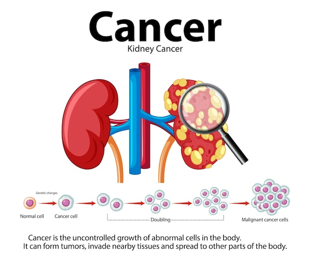 Detailed Illustration of Kidney Cancer Anatomy and Cells | Jiffy Designs