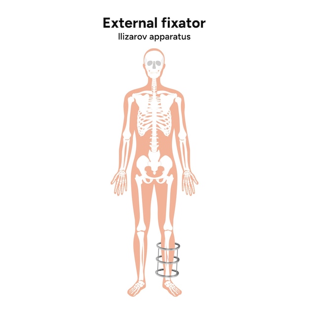 Detailed Anatomical Illustration of an External Fixator Device | Jiffy ...
