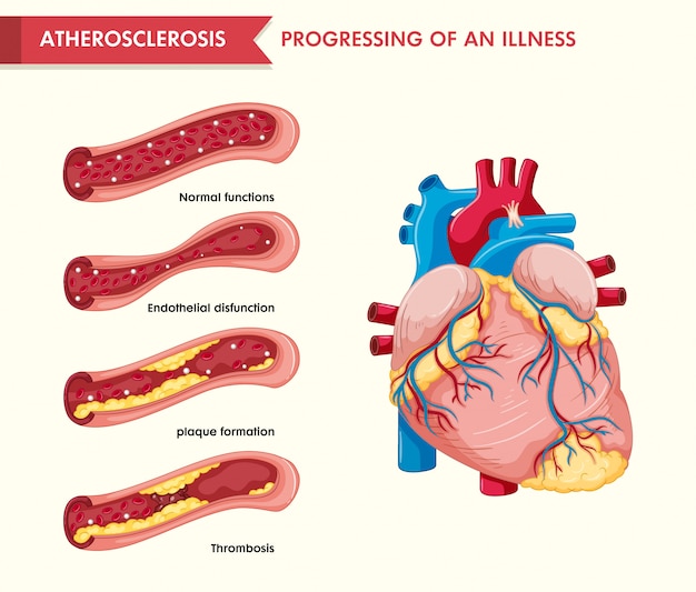 Detailed Anatomy of Atherosclerosis: A Visual Journey Through the ...