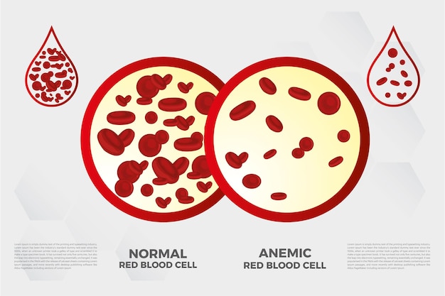 Captivating Comparison of Normal and Anemic Red Blood Cells | Jiffy Designs