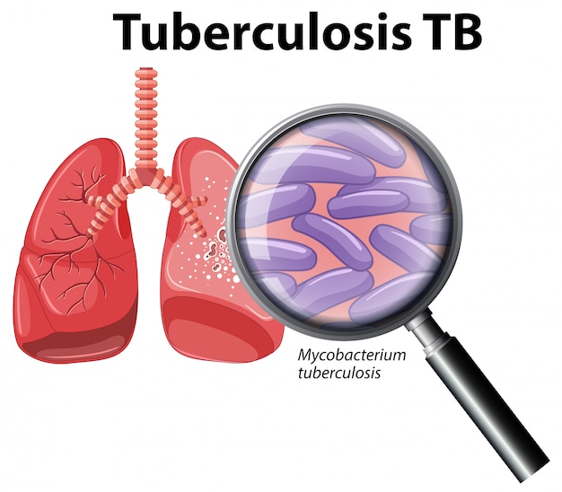 Detailed Illustration of Tuberculosis TB Infection and Bacteria | Jiffy ...