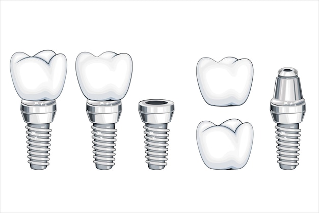 Detailed Dental Implant Components: Crowns, Abutments, and Fixtures ...