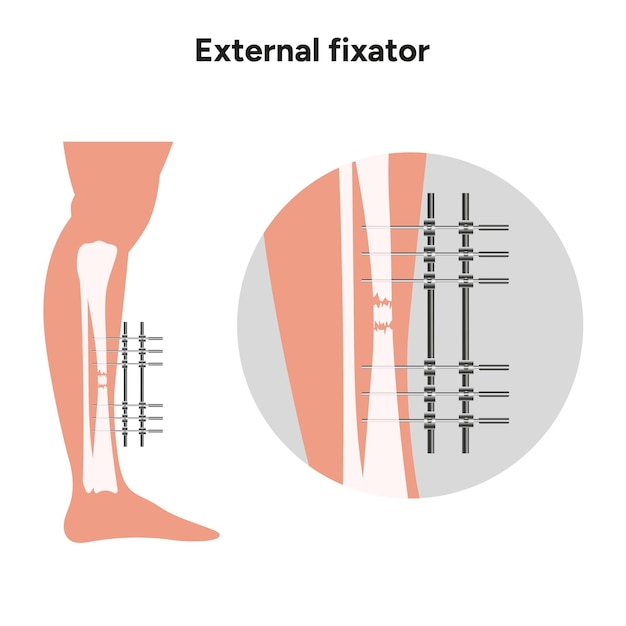 Detailed Illustration of an External Fixator Device for Leg Injuries ...