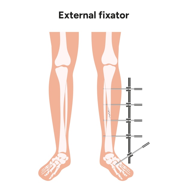 Detailed Illustration of an External Fixator for Leg Fractures | Jiffy ...