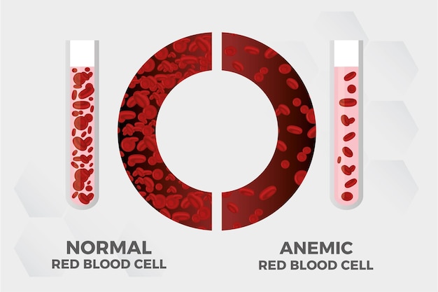 Comparing Normal and Anemic Red Blood Cells in Captivating Visual ...