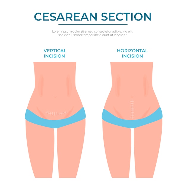 Detailed Illustration of Cesarean Section Incision Types | Jiffy Designs