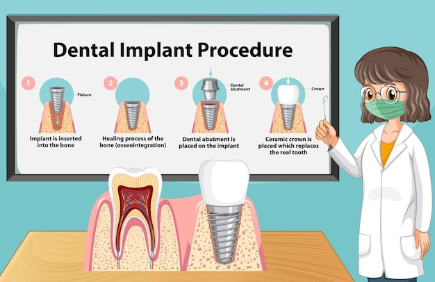 Comprehensive Guide to Dental Implant Procedure with Detailed Visuals ...